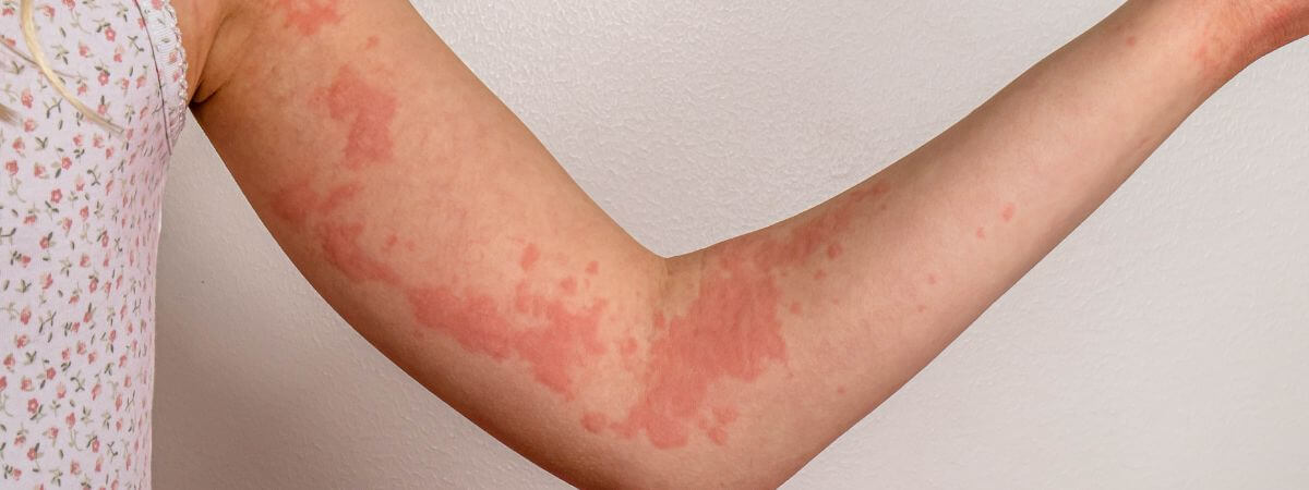 Urticaire : aliments à éviter et conseils pour prévenir les crises